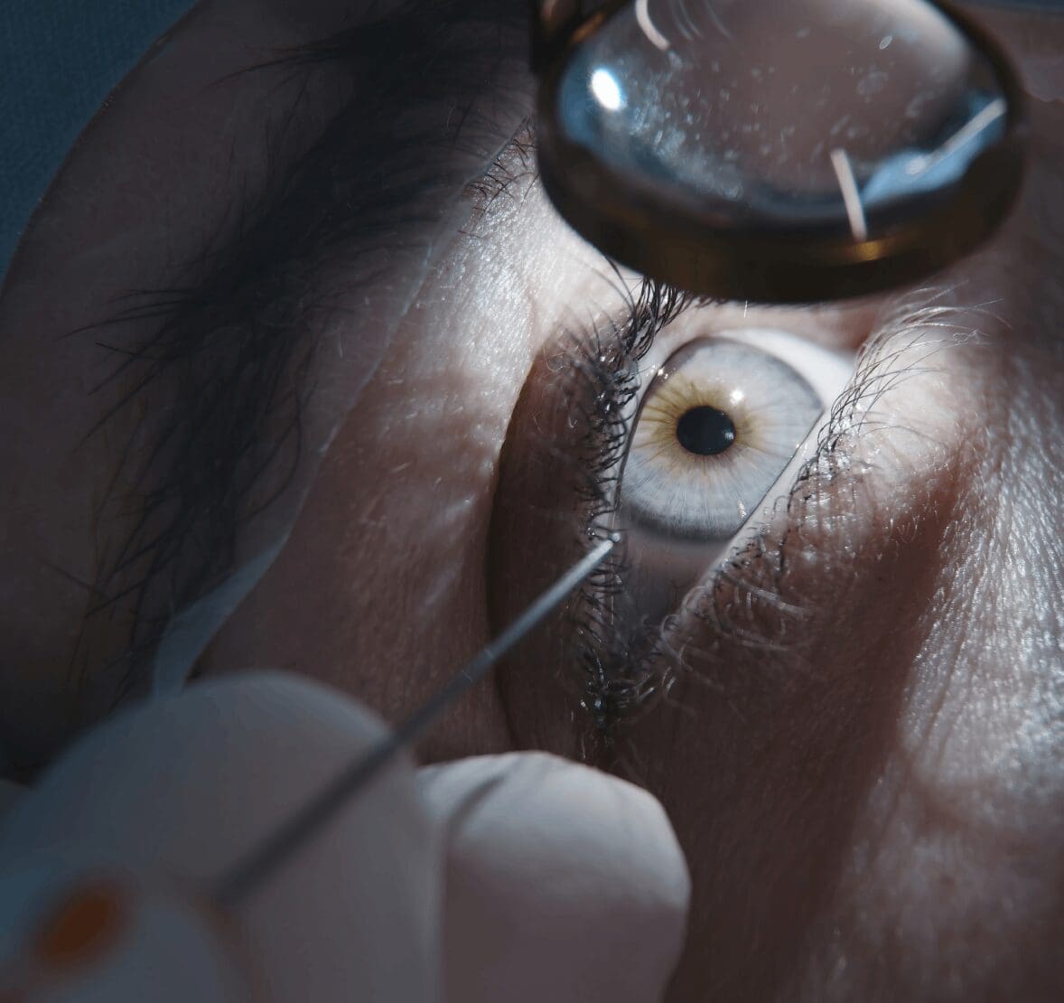 Other Eye Surgeries | Corneal Surgery by CA Eye Surgeons